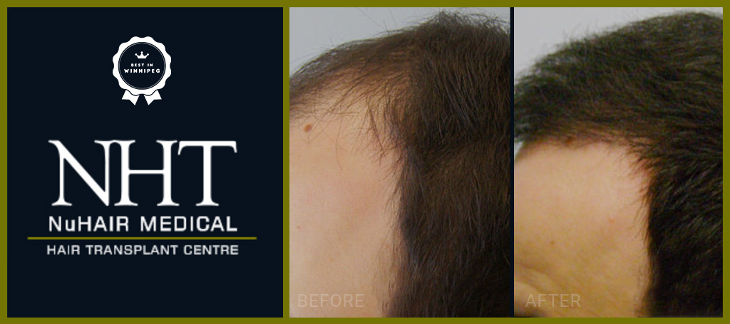 The 4 Places to Get the Best Hair Transplant in Winnipeg [2026]
